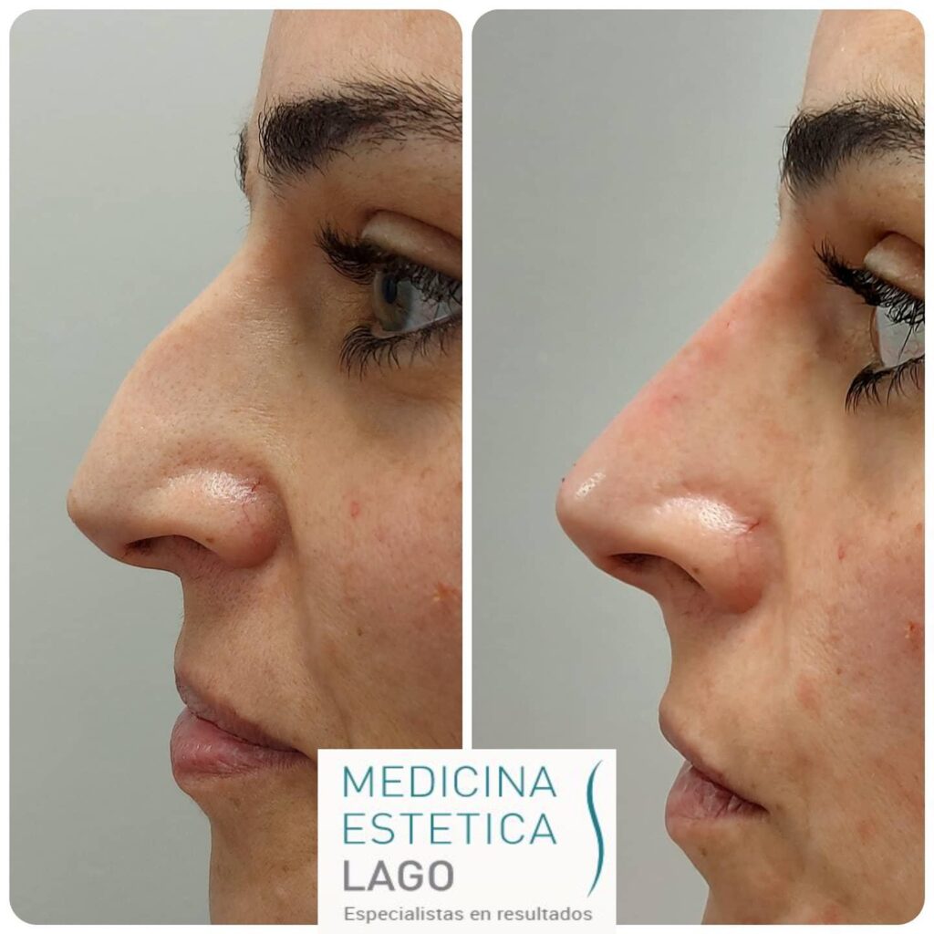 Remodelación de nariz sin cirugía: ¿Cuánto cuesta? ※